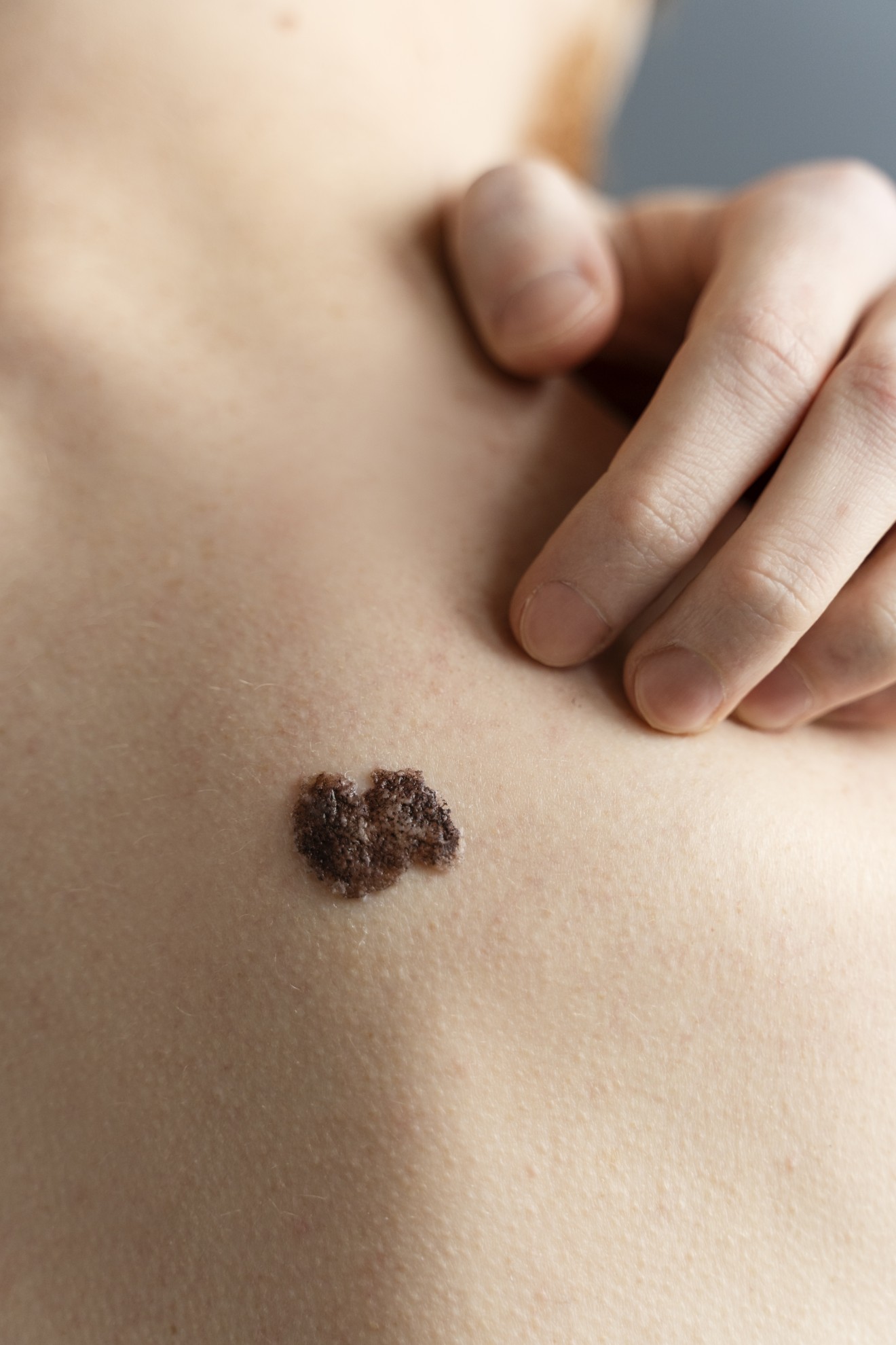 Cáncer de piel: señales en lunares que no debes ignorar - Centro Médico ...